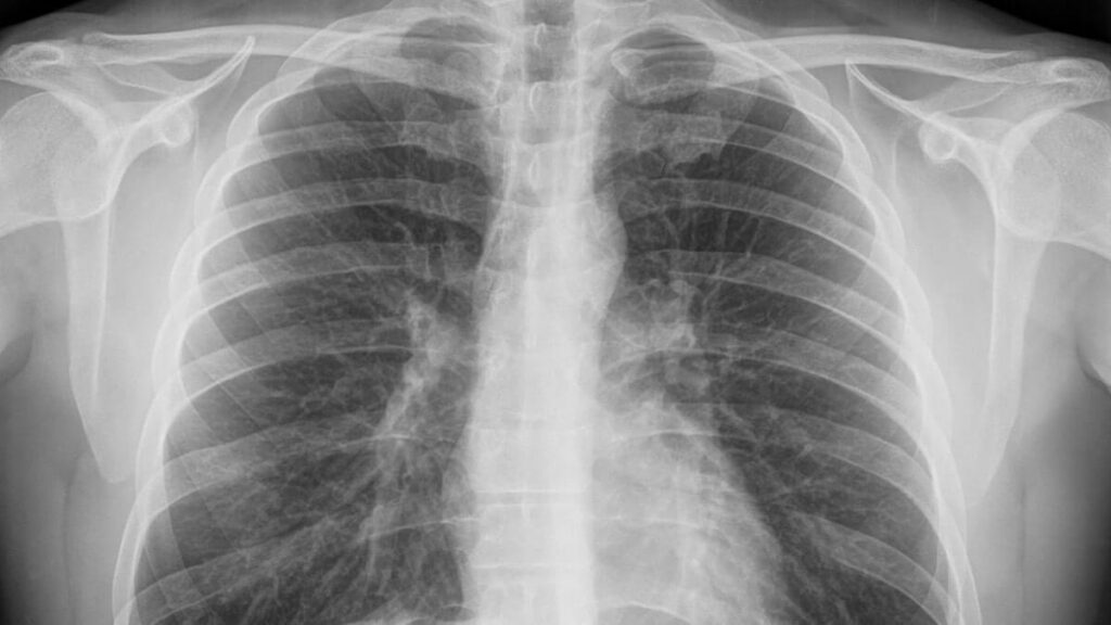 O femeie care credea că are TBC, de fapt, avea un prezervativ în plămâni